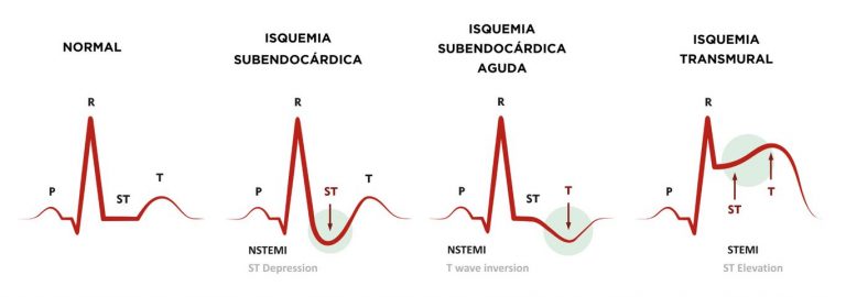 Avaliação do eletrocardiograma na Síndrome Coronariana Aguda com ...