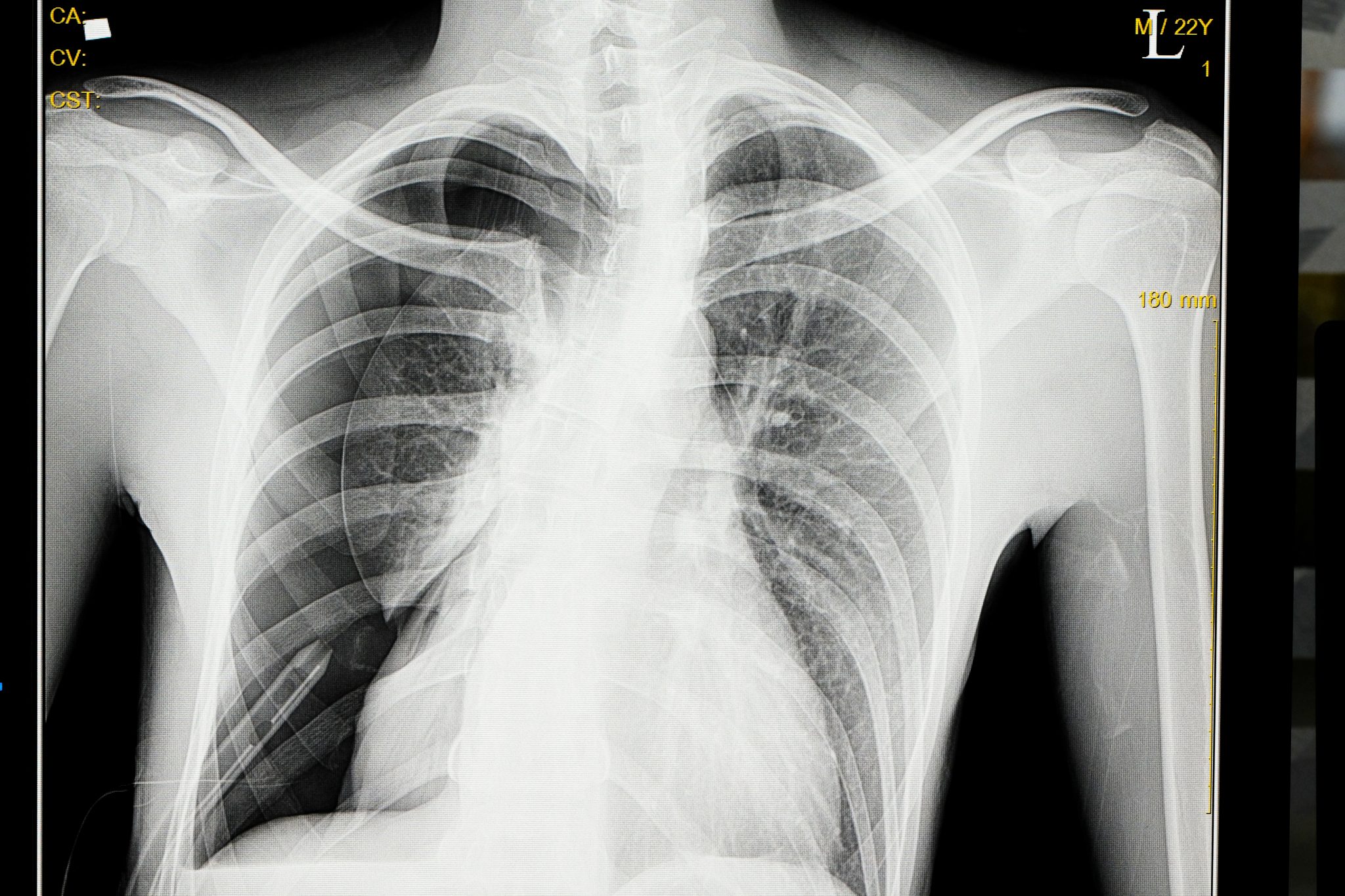 Pneumotórax espontâneo primário: quando pensar? - CUREM