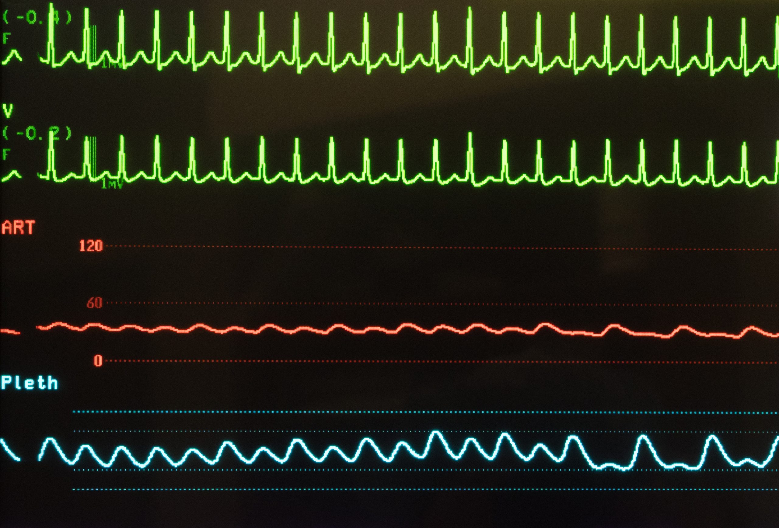 Taquicardia Supraventricular na emergência pediátrica: Diagnóstico e ...